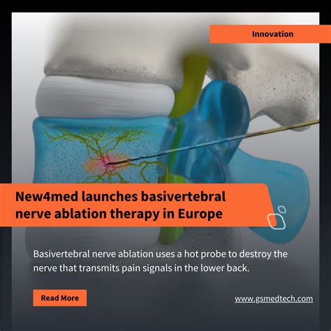 New4med Launches Basivertebral Nerve Ablation Therapy In Europe