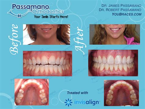 Couldnt Bite Lettuce Open Bite Fixed With Invisalign Orthodontics Passamano Orthodontics