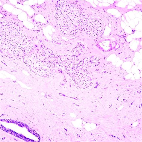 Th E Focus Of Columnar Cell Hyperplasia Surrounded By Tubular Carcinoma Download Scientific