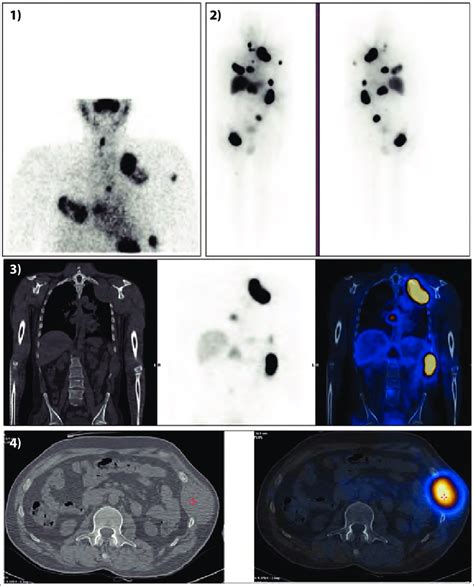 99m Tc Pertechnetate Thyroid Scan Showing Small Residual Thyroid