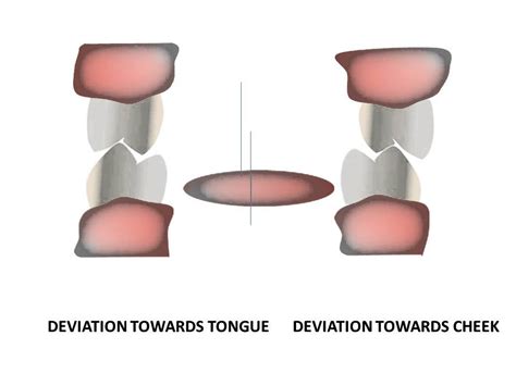 What Is The Occlusal Interference At Tina Gentle Blog