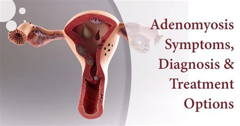 Adenomyosis Symptoms Diagnosis And Treatment Options
