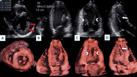 Comparative 2d And 3d Transthoracic Echocardiogram Images Top And