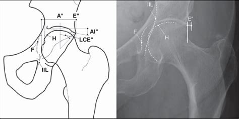 Schematic Left And Radiographic Right Presentations Of Protrusio Download Scientific