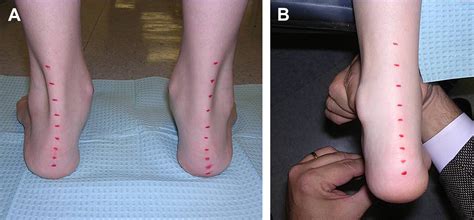 Clinical Diagnosis And Assessment Of The Pediatric Pes Planovalgus