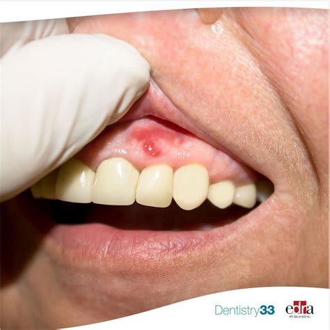 Apical Periodontitis And Autoimmune Diseases Dentistry33