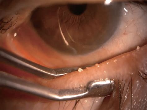 Meibomian Gland Expressor Op Tech By Robert
