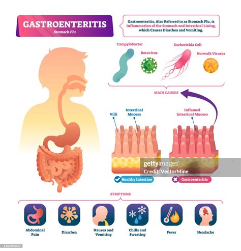 Gastroenteritis Vector Illustration Labeled Stomach Inflammation Scheme