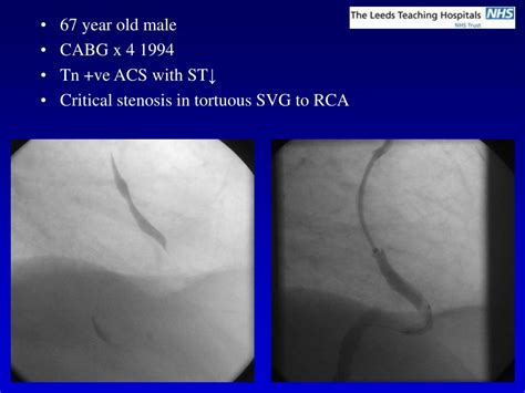 Ppt Proxis Proximal Embolic Protection In Saphenous Vein Graft And Infarct Pci Powerpoint