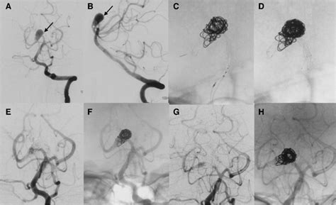 A B A 52 Year Old Women Presenting With An Unruptured Dissecting