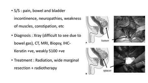 Malignant Bone Tumors Nutshell Ppt