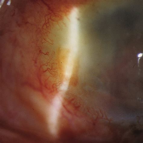 A Superior Congested Scleral Nodule Was Noted Initially In The Left Eye