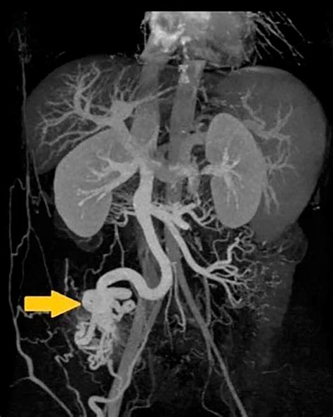 Contrast Enhanced Computed Tomography Reconstruction In The Portal