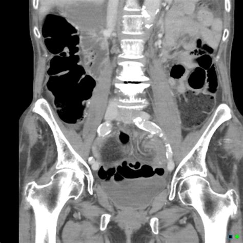 Radiopaedia Case Sigmoid Volvulus Failed Rectal Tube Decompression Id