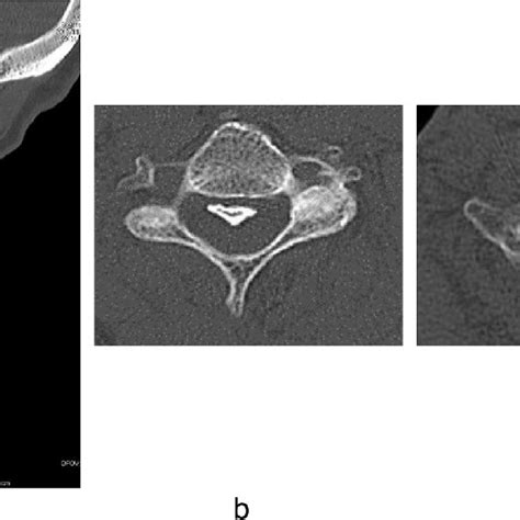 Preoperative Cervical Ct Scan Preoperative Cervical Ct Scan Revealed Download Scientific