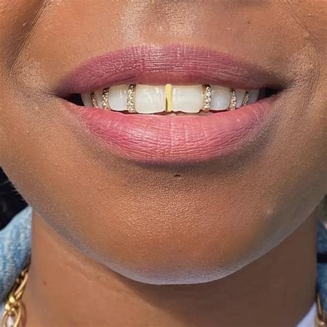 Teeth Fillers For Gaps Etsy