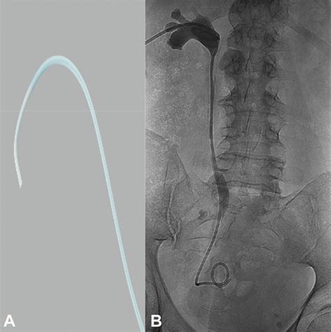 Evaluation Of Galdakao Modified Valdivia Position In Endoscopic Management Of Malignant Ureteric