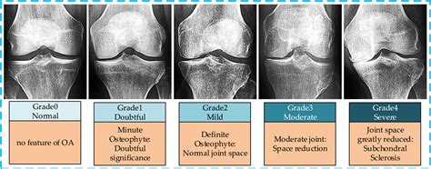 A Resnet‐based Approach For Accurate Radiographic Diagnosis Of Knee