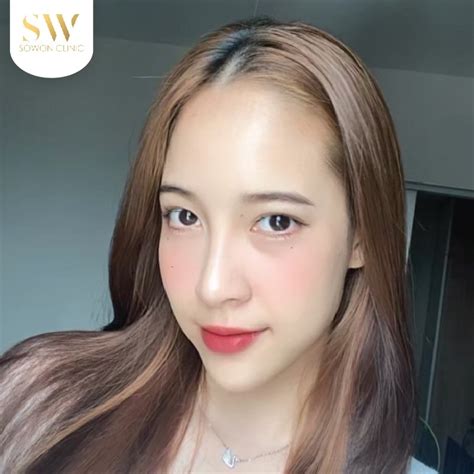 เสริมจมูกกี่วันแต่งหน้าได้ หลัง 3 วันแต่งหน้าได้จริงเหรอ