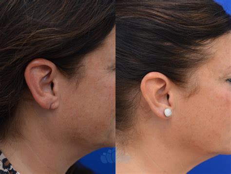 Earlobe Repair Before And After Pictures Case 88 Charlotte Nc