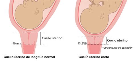 Cuello Uterino Corto — High Risk Pregnancy Information