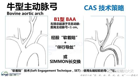 牛型主动脉弓（bovine Aortic Arch） 脑医汇