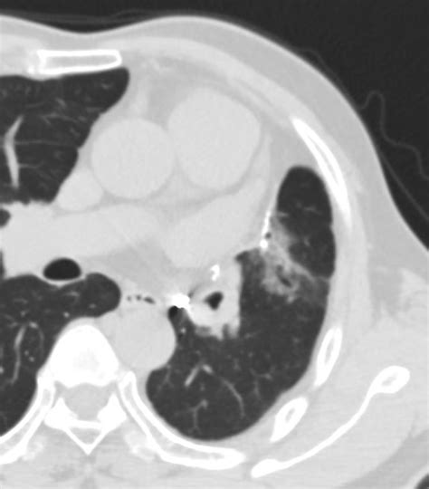 230lu Adenocarcinoma With Lepidic Growth And Recurrence At Suture Line The Common Vein