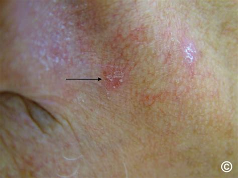 Actinic Keratosis
