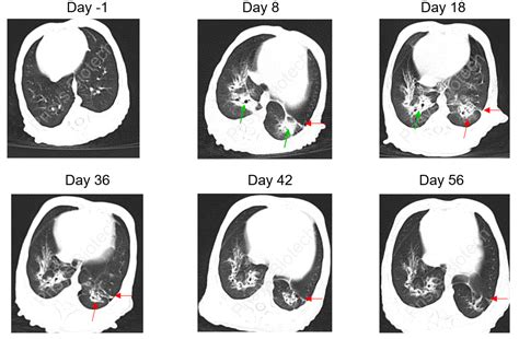 Idiopathic Pulmonary Fibrosis Ipf Model Research Gene Therapy
