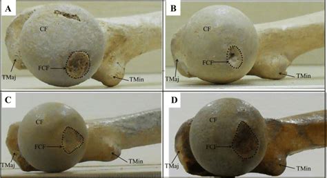 Fovea Capitis Of Femur Pipkin Classification Template And Example Free