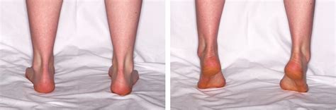 Bofas Hyperbook Mid And Hindfoot Pes Planus