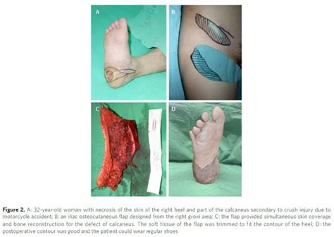 Microsurgery For Upper And Lower Extremity Reconstruction And Limb