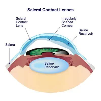 Optometrist Fitted Scleral Contact Lenses In Edmonton