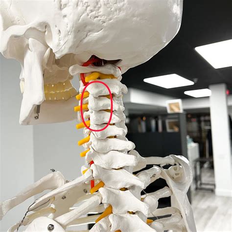 Facet Joint Dislocation At Brittany Cray Blog