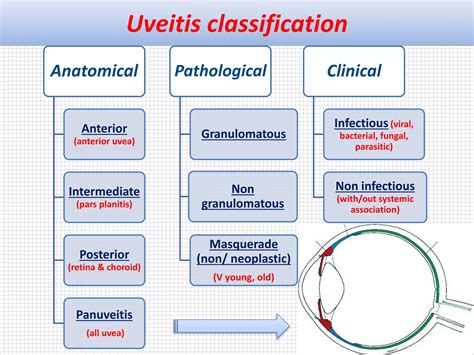 Uveitis Pptx