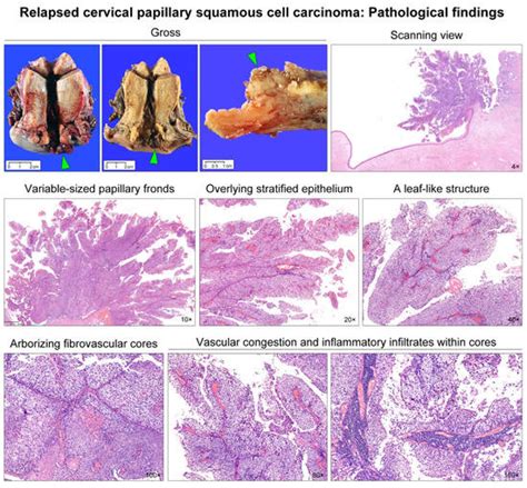 What Is Invasive Squamous Cell Carcinoma Cervix