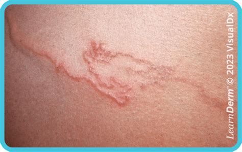 Recognizing Configurations Learnderm