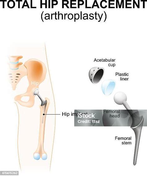 Total Hip Replacement Or Arthroplasty Stock Illustration Download