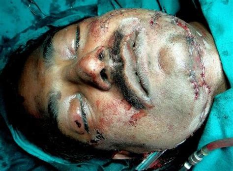 Post Op After Reconstruction Of Avulsed Lower Jaw Download Scientific