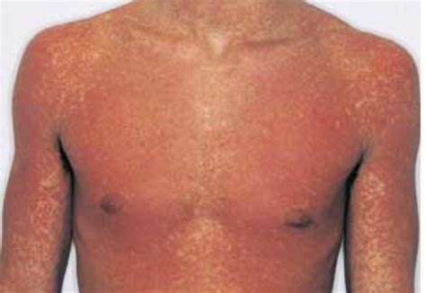 Exanthème Mononucléose Morbilliforme