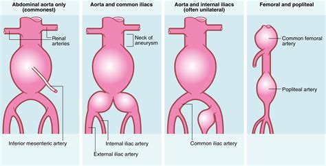 Aneurysms And Other Peripheral Arterial Disorders Clinical Tree