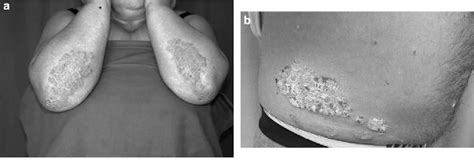 Figure 1 From Hypodermal Adipose Tissue Sonoelastography For Monitoring