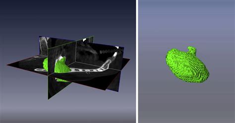 Graphic Representation Of The Cystic Volume Before Marsupialization