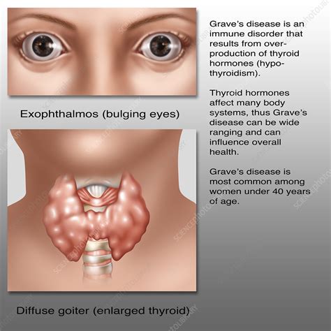 Graves Disease Illustration Stock Image C0436116 Science Photo