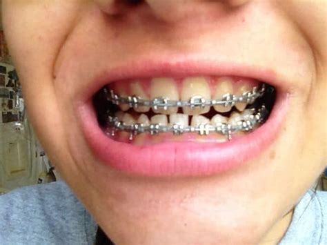 Oral Hygiene While Wearing Braces Dundas Wilson The Science Of Car