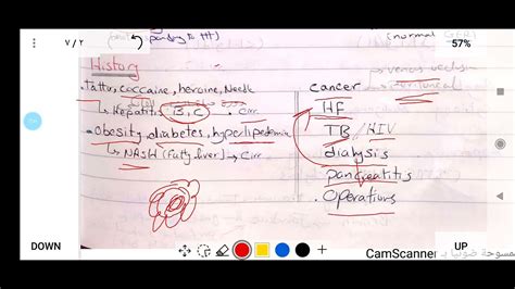 Ascites Part Two History Clinical Picture Imaging Treatment