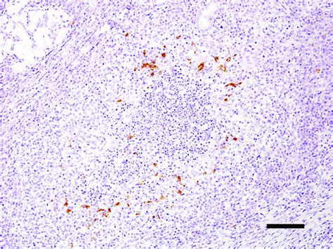 Photomicrograph Of A Section Of The Mesenteric Mass After Download