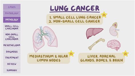 Video Lung Cancer And Mesothelioma Pathology Review Osmosis