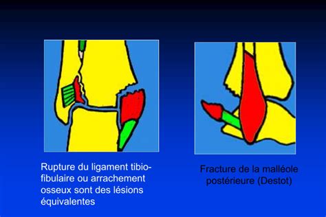 9cheville Fractures