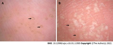 Dermoscopy Porokeratosis